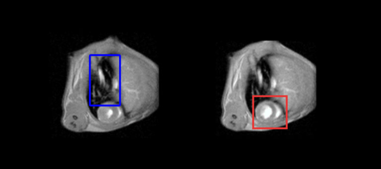 A Total Eclipse of the Heart through MRI – RS2D